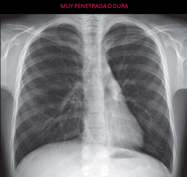Pruebas de Función Pulmonar y Ayudas Diagnosticas: PLACA DE RX. TORAX