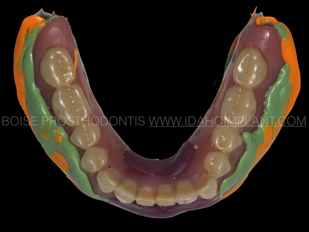 Boise Idaho Prosthodontics
