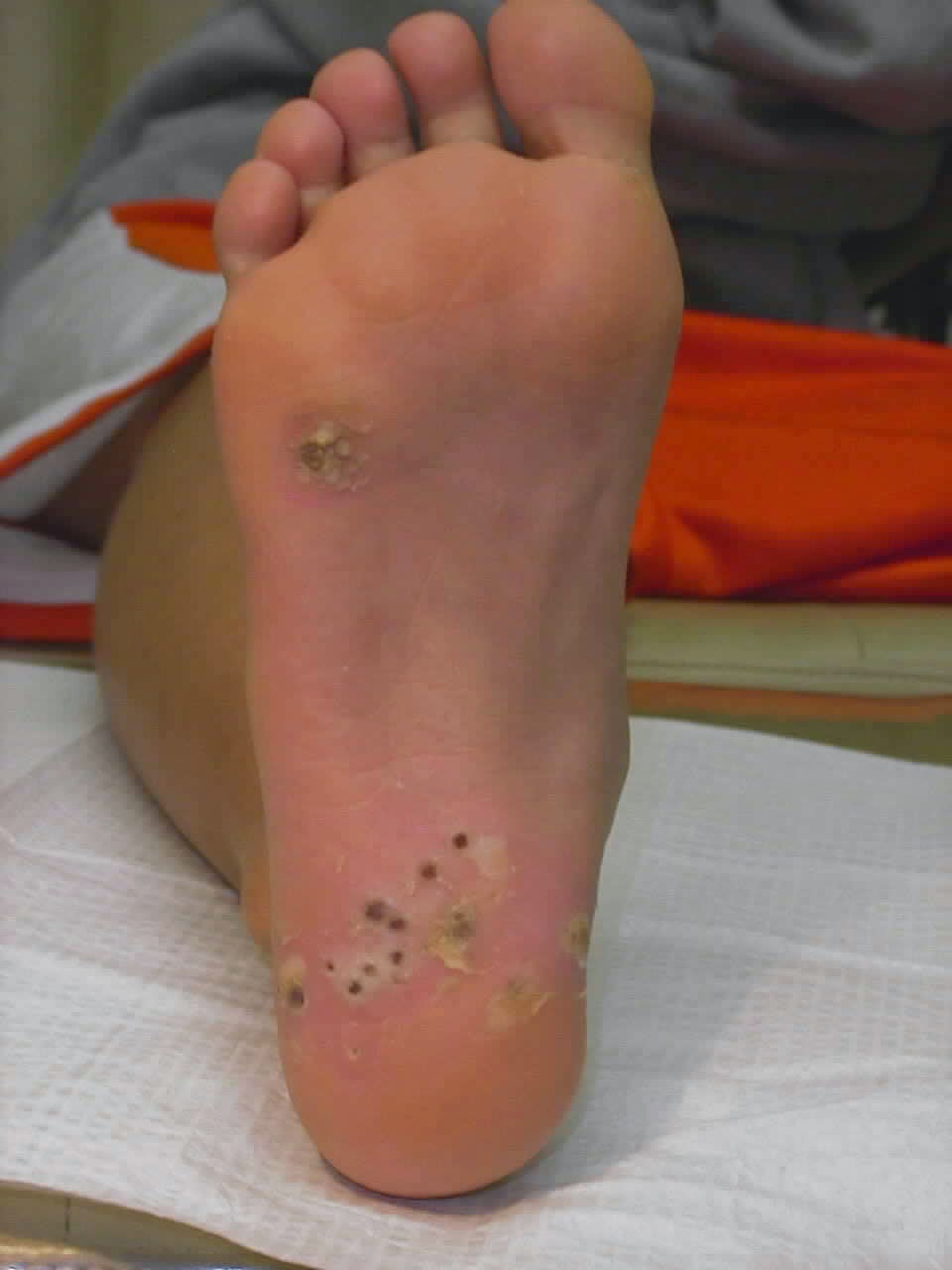 Photos of Plantar Warts ~ How To Remove Moles, Warts, Skin Tags Safely