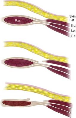 KirURGy: Capítulo 14: Separação Posterior de Componentes