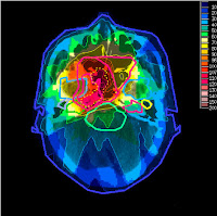 365 Days of Medical Physics: The basics of IMRT: an overview