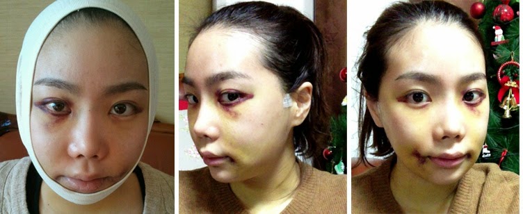 ID Hospital Korea: Two jaw surgery, cheekbone reduction amazing before ...