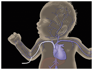 Within Pediatrics: It's a Family Matter: Learning about PICC Lines and ...