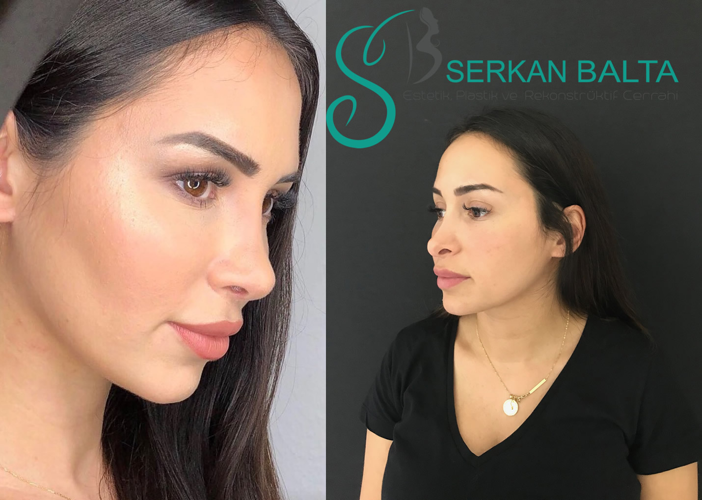 Health Zone Turkey: Facelift in İstanbul / Turkey