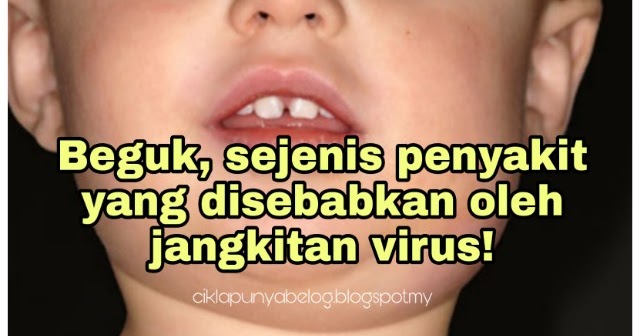 Beguk, sejenis penyakit yang disebabkan oleh jangkitan virus!