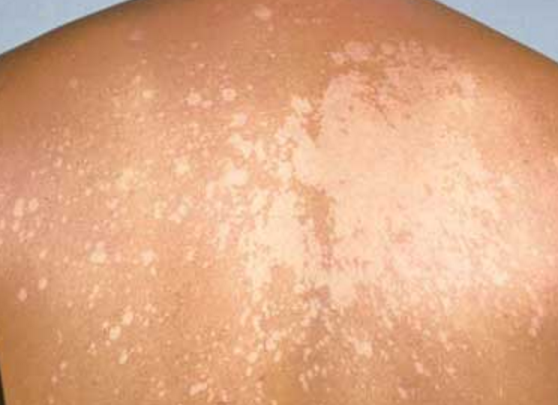 8 Jenis Penyakit Kulit, Pengertian dan Penjelasannya Lengkap ...