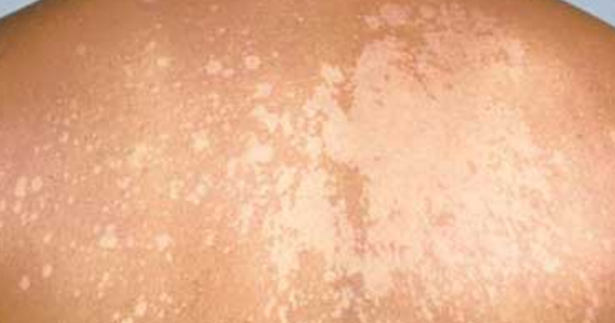 8 Jenis Penyakit Kulit, Pengertian dan Penjelasannya Lengkap ...