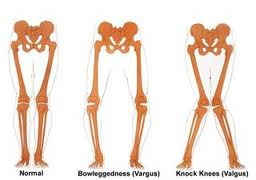 Exercise and Posture: Q Angle