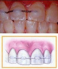 Omni Dental Group: Splinting Teeth