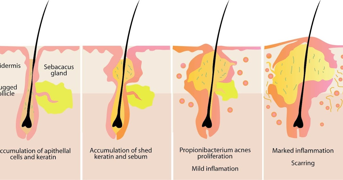 Tratamiento del acné ¿Qué es sebo