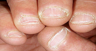 Brittle splitting nails - Awesome Nail