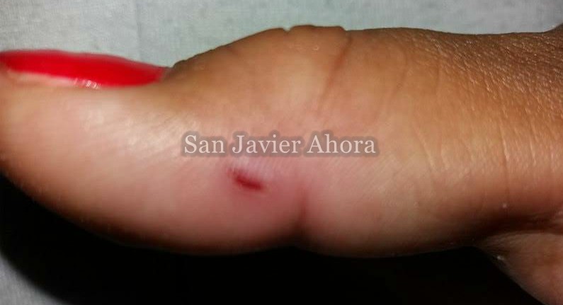 FUE A MIRAR EL CARNAVAL DE SAN JAVIER Y TERMINÓ MORDIDA POR UNA RATA ...