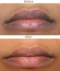 PerfectMélange: Darkening of The Lips...Causes & Remedies