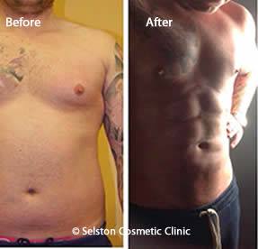 Selston Cosmetic Clinic: Achieve Six-Pack Abs With Vaser Hi-Def ...