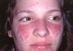 Found Malar Rash on your face, Beware of Lupus Erythematosus