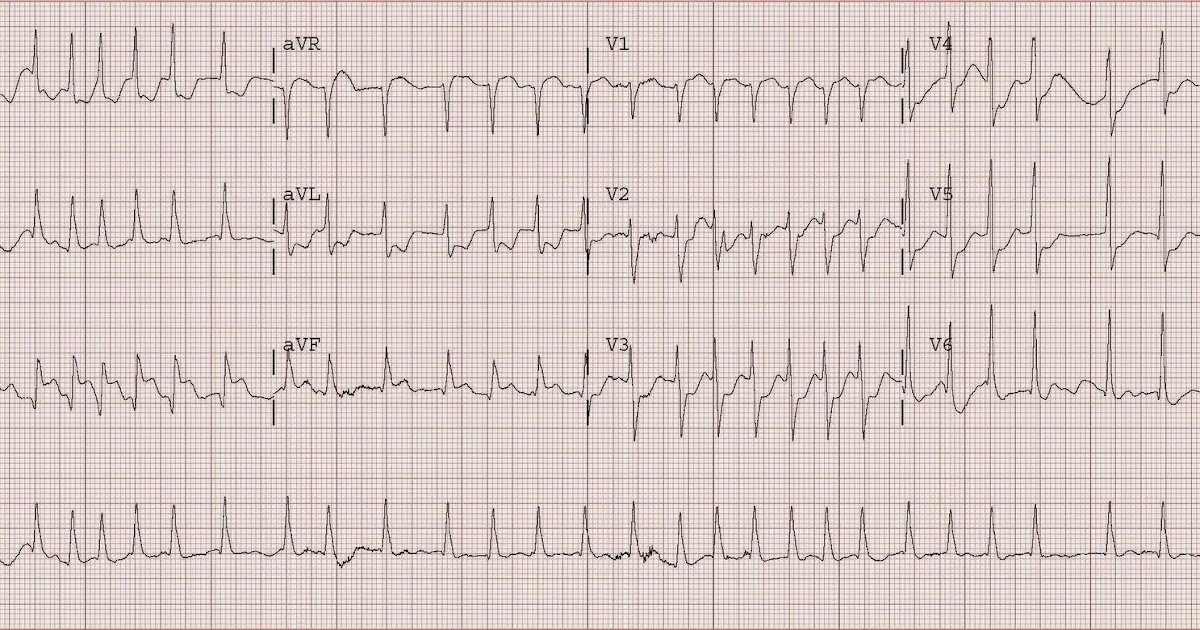 Dr. Smith's ECG Blog: Atrial fibrillation with rapid ventricular ...