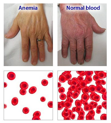 Wellness Lab Health Info: How Is Anemia Diagnosed?