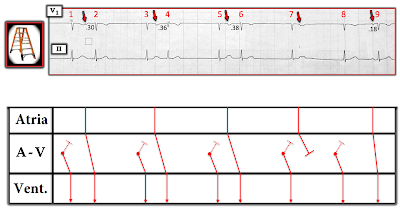 ECG Interpretation: ECG Blog #163 (Escape-Capture - Wenckebach - SA ...