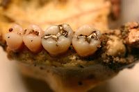 Dental Tooth Fairies: Question 1 (Part 2): Forensic Dentistry in ...