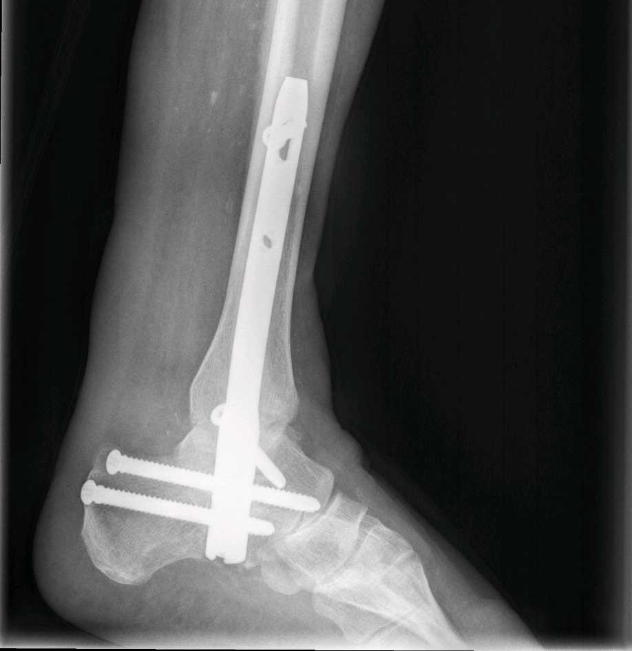Fanáticos del pie: ATLAS DE PATOLOGIA DEL PIE: ARTRODESIS TOBILLO CON ...