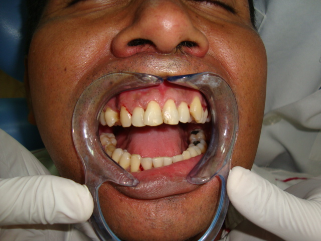 Dr. Alex Polit Luna- Cirujano Oral y Maxilo Facial.: Fractura Mandibular