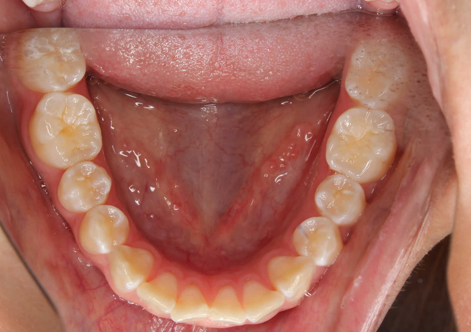 Br@ndy's Invisalign Journey: June 2011