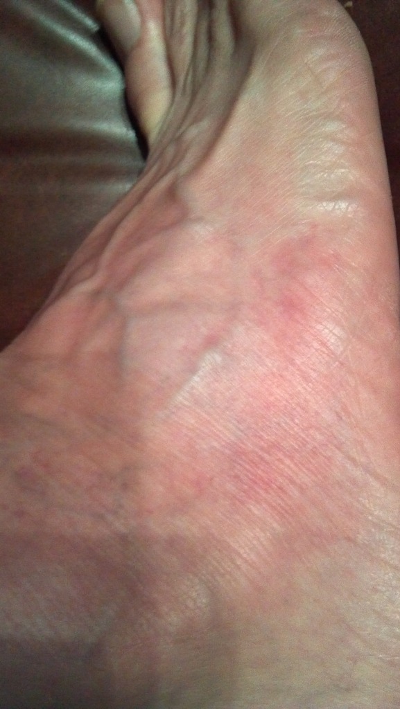 Chris' peroneal tendon surgery: How It All Started