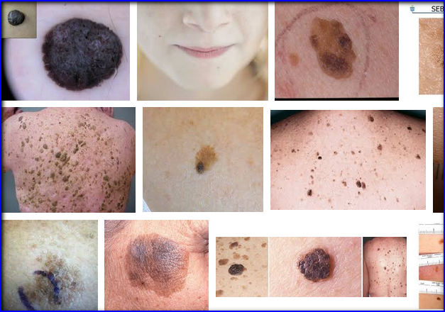 Seborrheic Keratosis Vs Melanoma Signs Causes Treatments Preventions