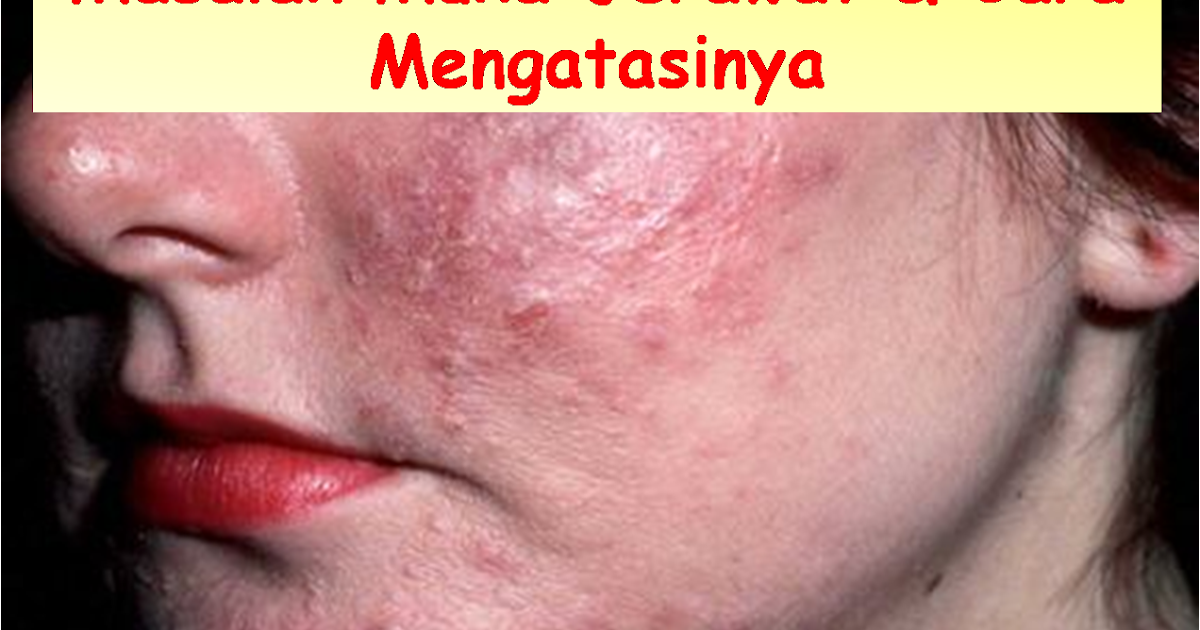 Masalah Kulit Muka Berjerawat dan Cara Mengatasinya | VITAMIN UMMI ZARA ...