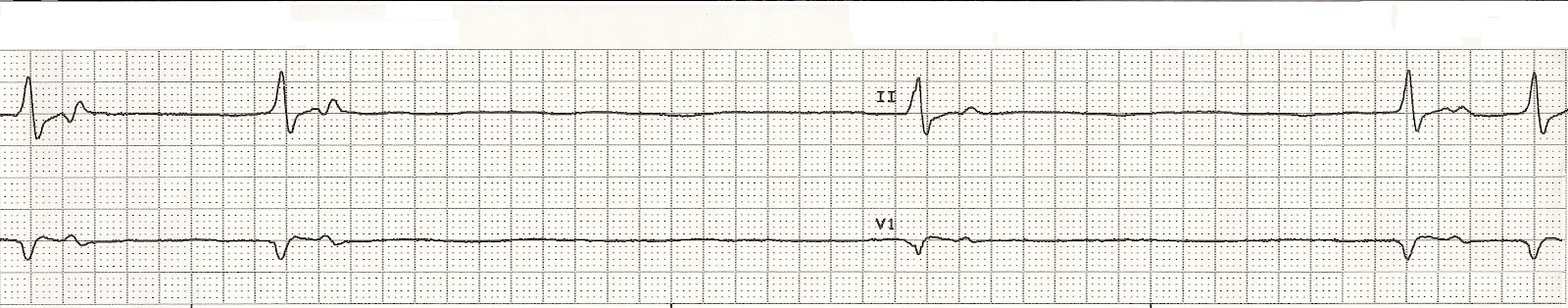 EKG Rhythm Strip Quiz 42