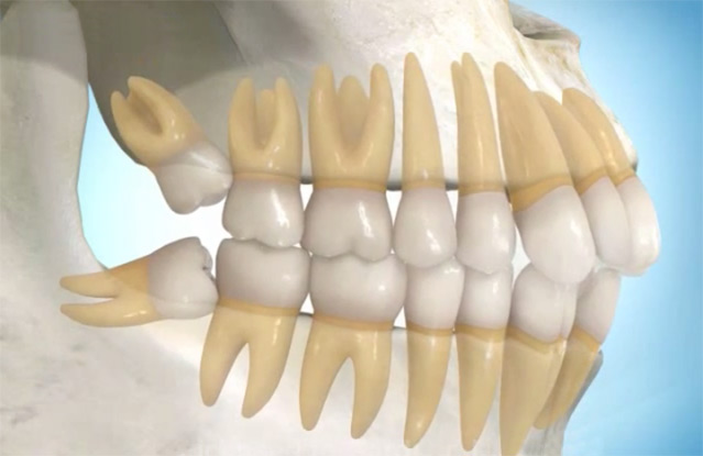 Bailey Orthodontics More On Wisdom Teeth And Braces