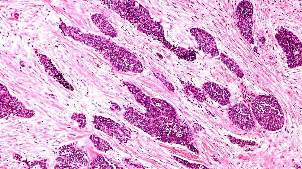 Desmoplastic small-round-cell tumor