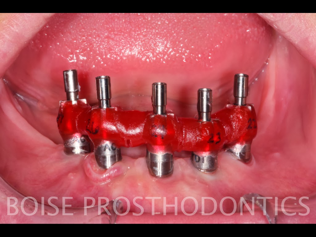Boise Idaho Prosthodontics: Intra-oral Luting of Implant Verification ...