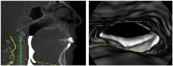 Facial Development Newsletter: THE SCIENCE BEHIND THE HOMEOBLOCK™ APPLIANCE