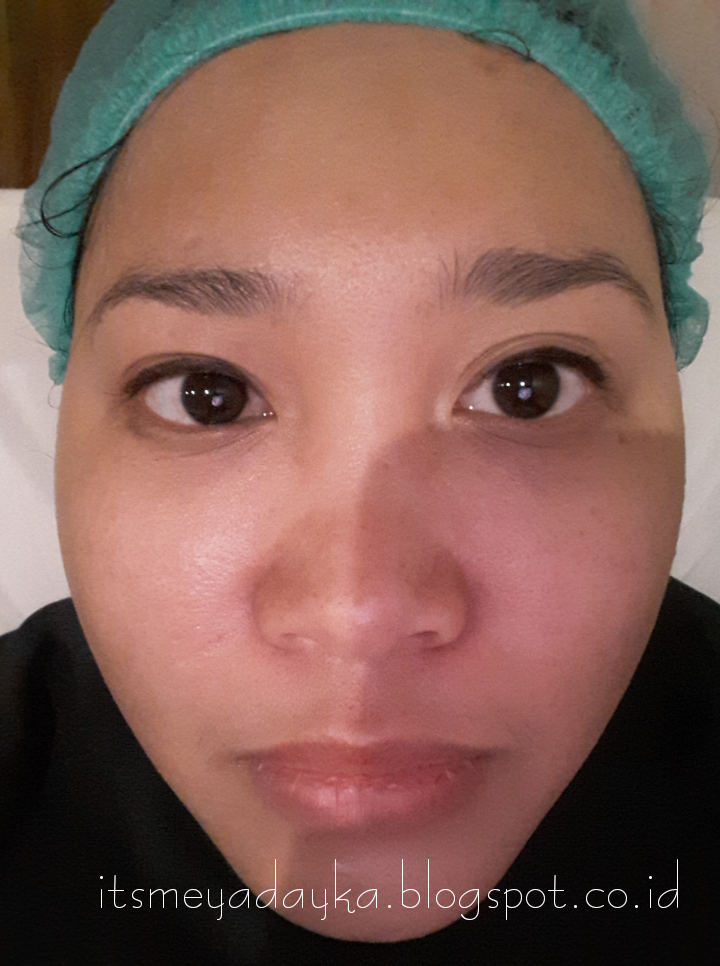 Review: Facial Peeling Klinik Eva Mulia