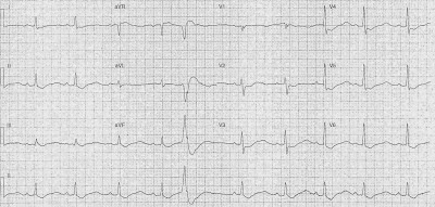 ECG of the Week: ECG of the Week - 11th March 2013
