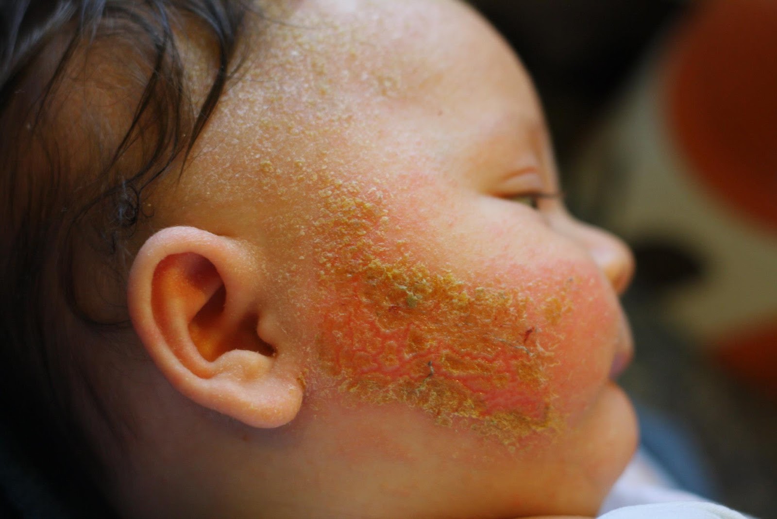 Momma Mom: Eczema Story - with pictures