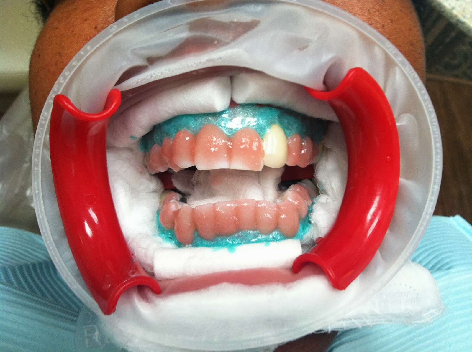 DrChetDMD: KOR In-Office Teeth Bleaching