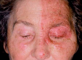 Free For Health: What Is Herpes Zoster Ophthalmicus (HZO)?
