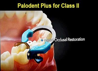PALODENT PLUS: Sectional Matrix System for Class II