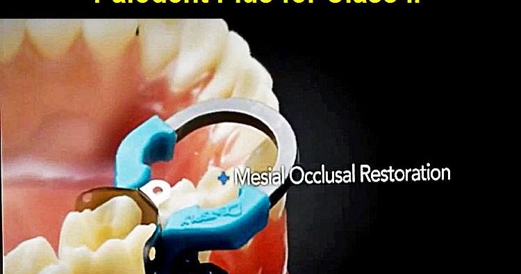 PALODENT PLUS: Sectional Matrix System for Class II - Odonto-Tv
