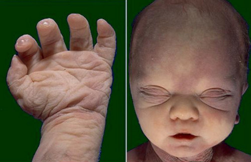 Potter's Syndrome Pictures | Medical Pictures and Images - (2023 Updated)
