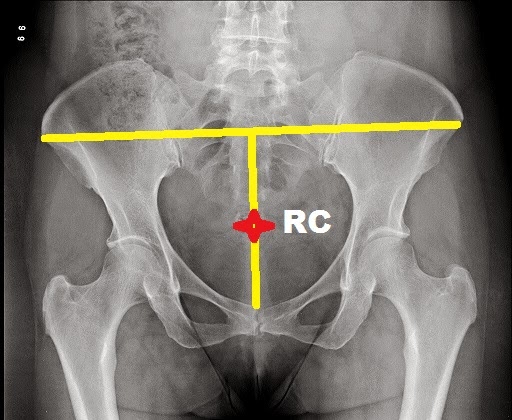 Posiciones Radiográficas de STIM: Rx Pelvis (Fte)