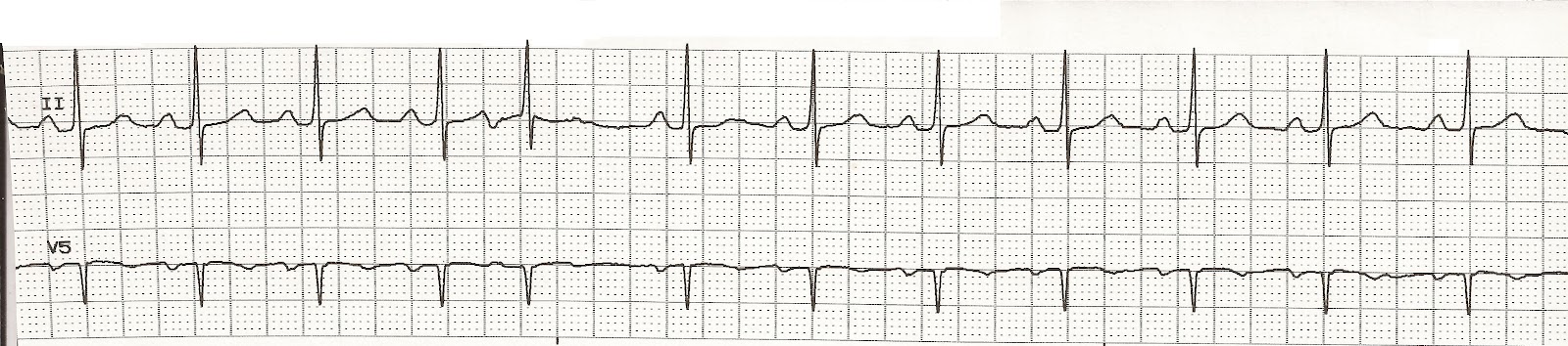 EKG Rhythm Strip Quiz 48