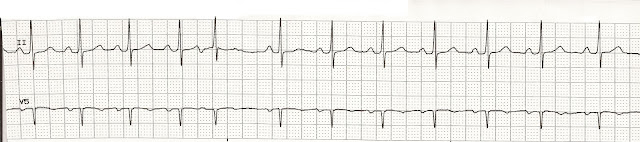 EKG Rhythm Strip Quiz 48