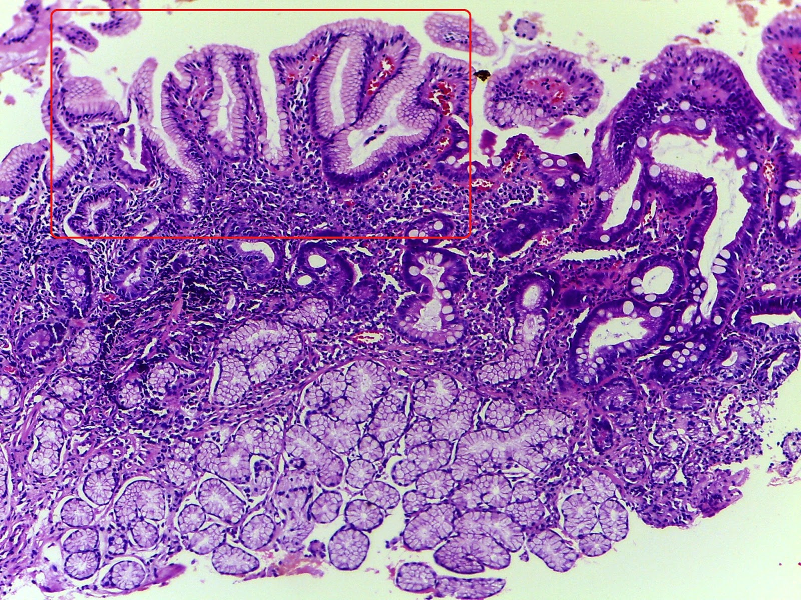 GASTROINTESTINAL AND LIVER HISTOLOGY PATHOLOGY ATLAS: DUODENUM: PEPTIC ...