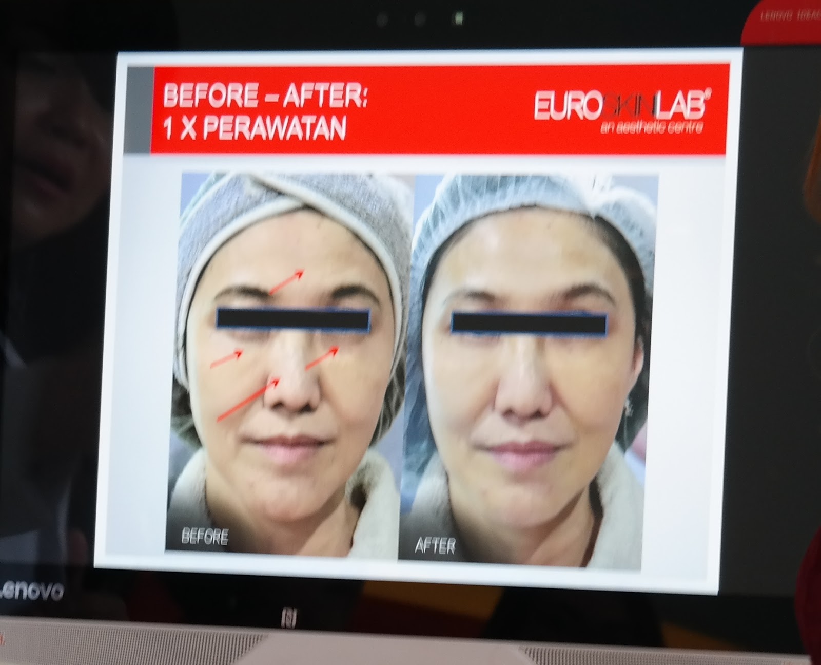Experiencing Intradermal Botox Facial Theraphy at Euro Skin Lab - Pink ...