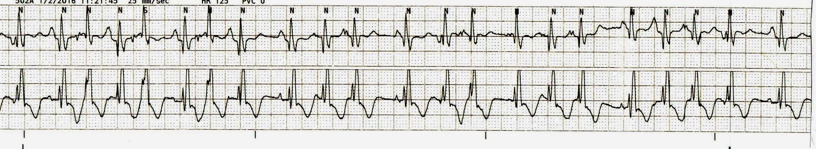 ECG Channel: Multifocal Atrial Arrhythmia