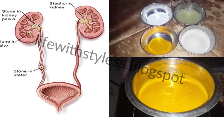 The Best Natural Remedy for Dissolving of Kidney Stones | Life With Styles