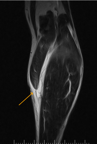 Tennis Leg- MRI - Sumer's Radiology Blog